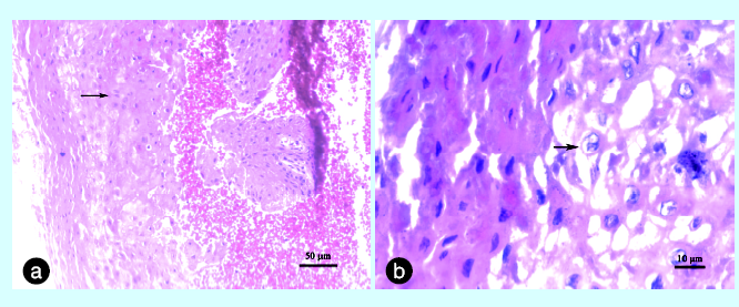 White Sponge Nevus Histology